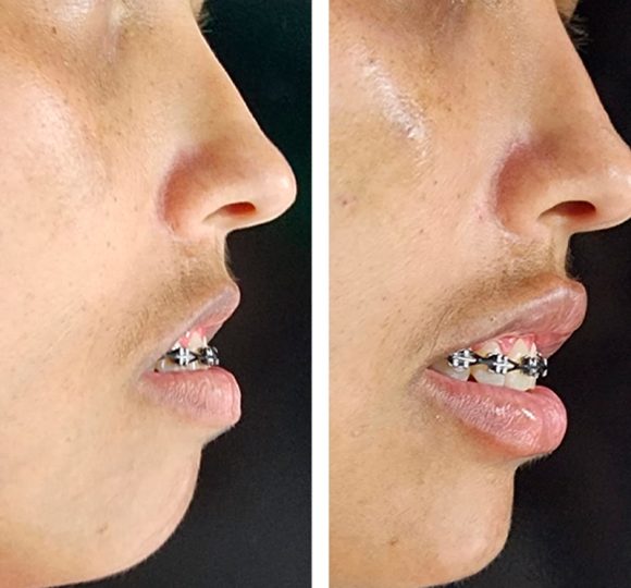 Preenchimento malar, pré maxila, lábio e mento – Clínica Rasc | Itanhomi