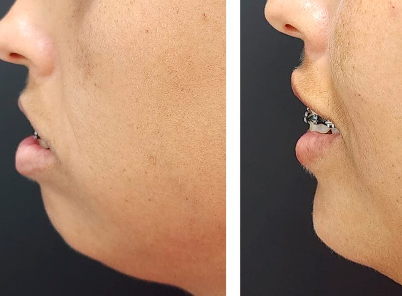 Antes e depois: Preenchimento malar e mento – Clínica Rasc | Itanhomi